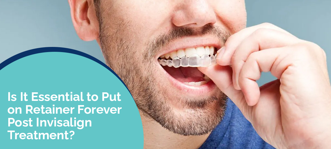 Is It Essential to Put on Retainer Forever Post Invisalign Treatment ...